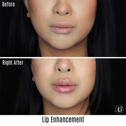 Northern Vancouver Lip Augmentation | Dr. Naz Cosmetics